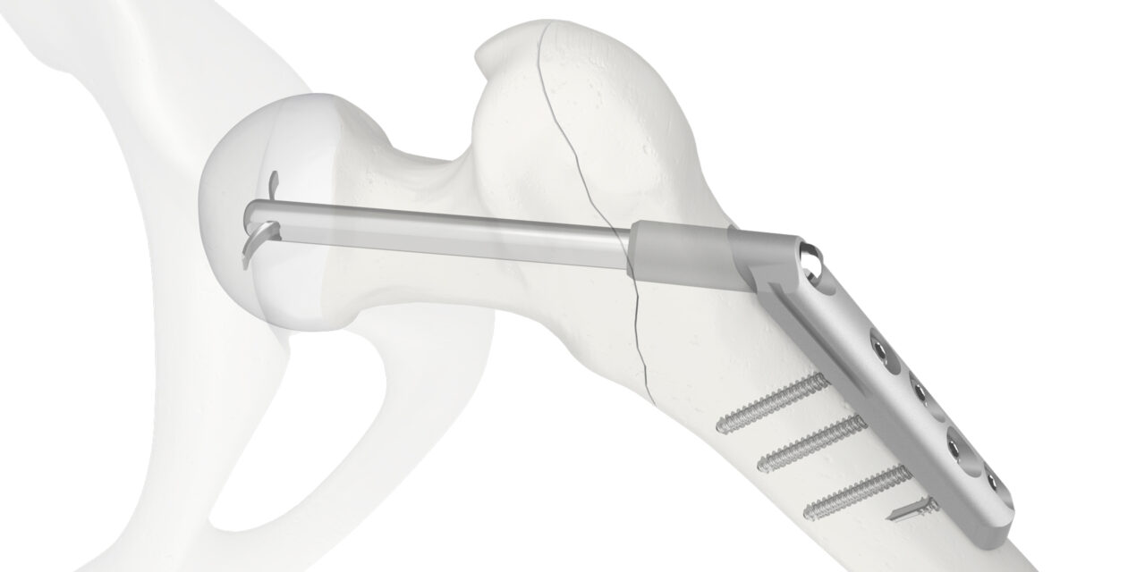 Hansson Twin Hook With Swemac Hip Plate - Swemac