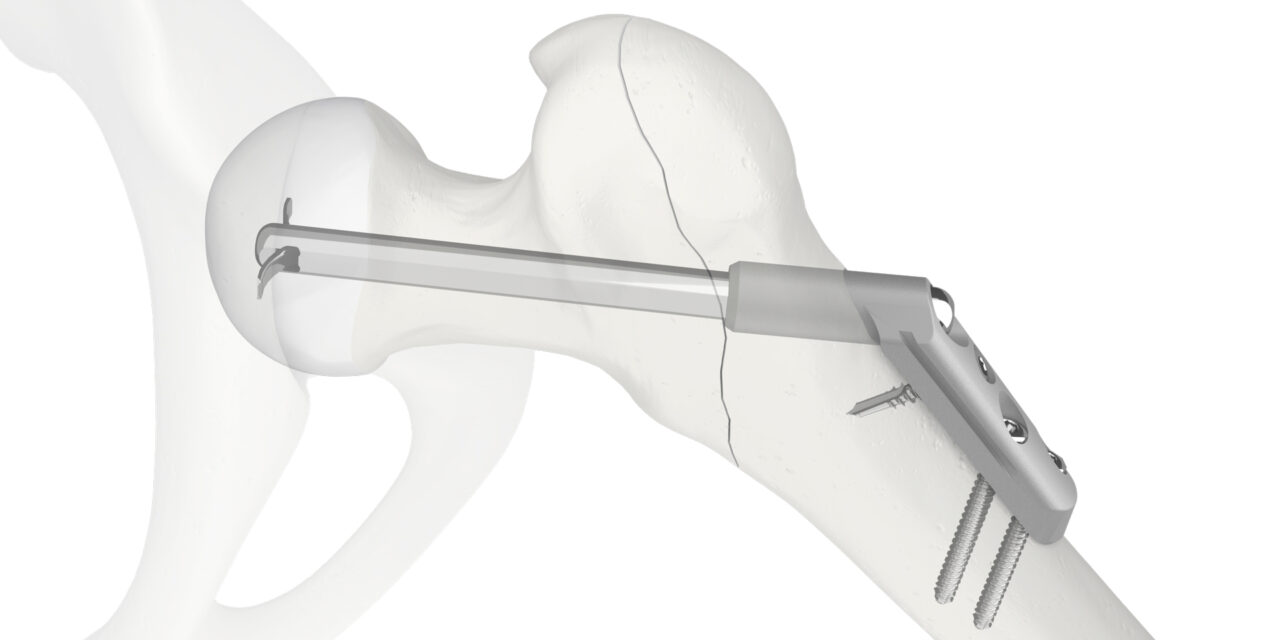 Hansson Twin Hook® With Twin Hook Locking Plate - Swemac