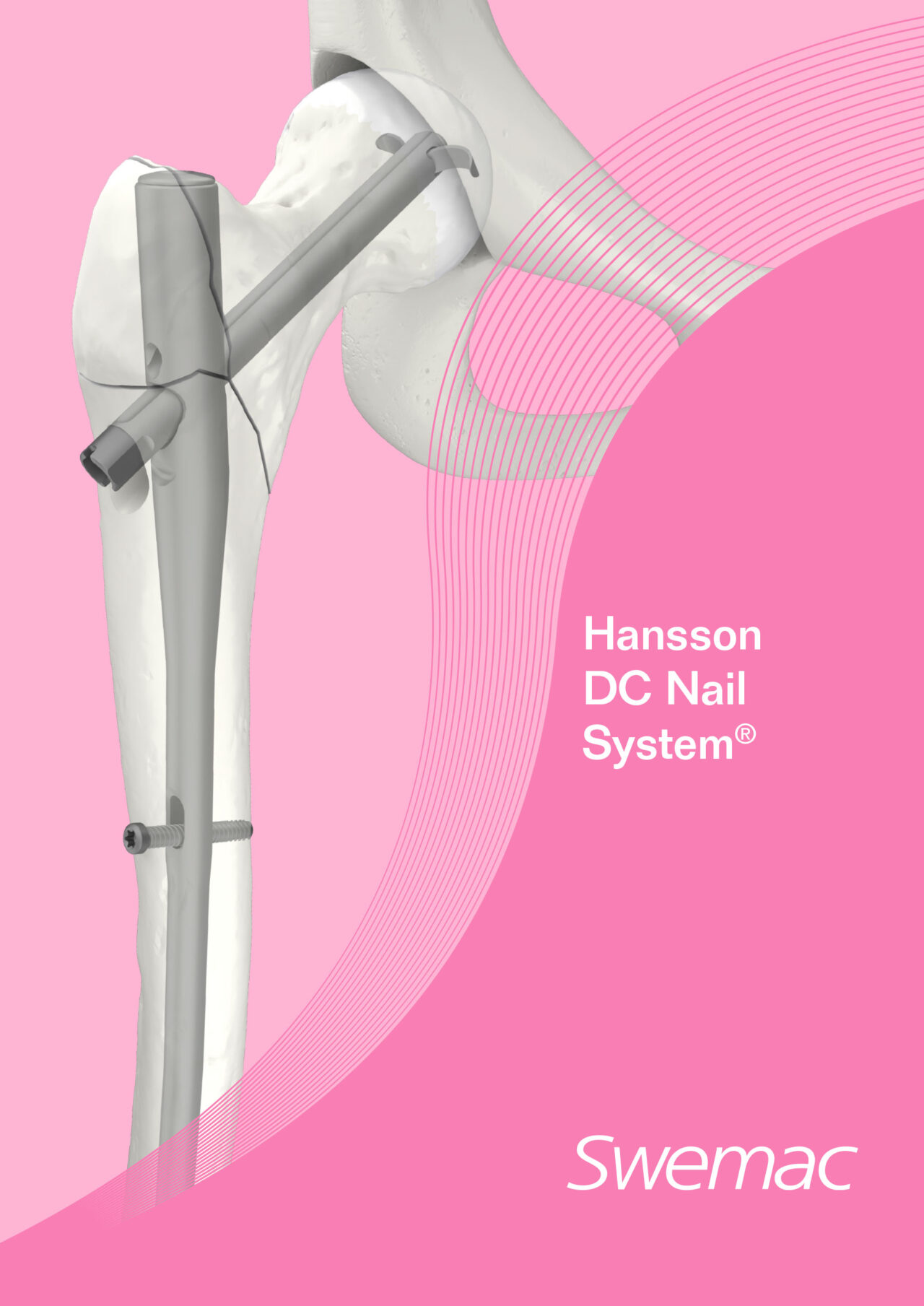 Hansson DC Nail - Swemac